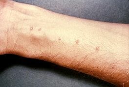 Bilharzia | Algemeen | Menselijk Lichaam - Menselijk Lichaam