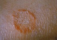 Dermatofytosis | Besmettelijke ziektes | Menselijk Lichaam - Menselijk ...