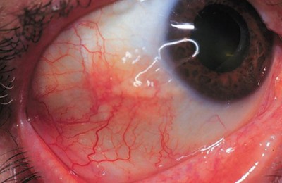 Episcleritis | Het oog | Menselijk Lichaam - Menselijk Lichaam