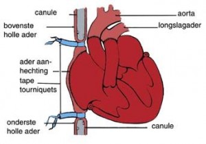 Harttransplantatie | Hart / circulatie | Menselijk Lichaam - Menselijk ...