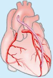 Kransslagader-bypass | Hart / circulatie | Menselijk Lichaam ...