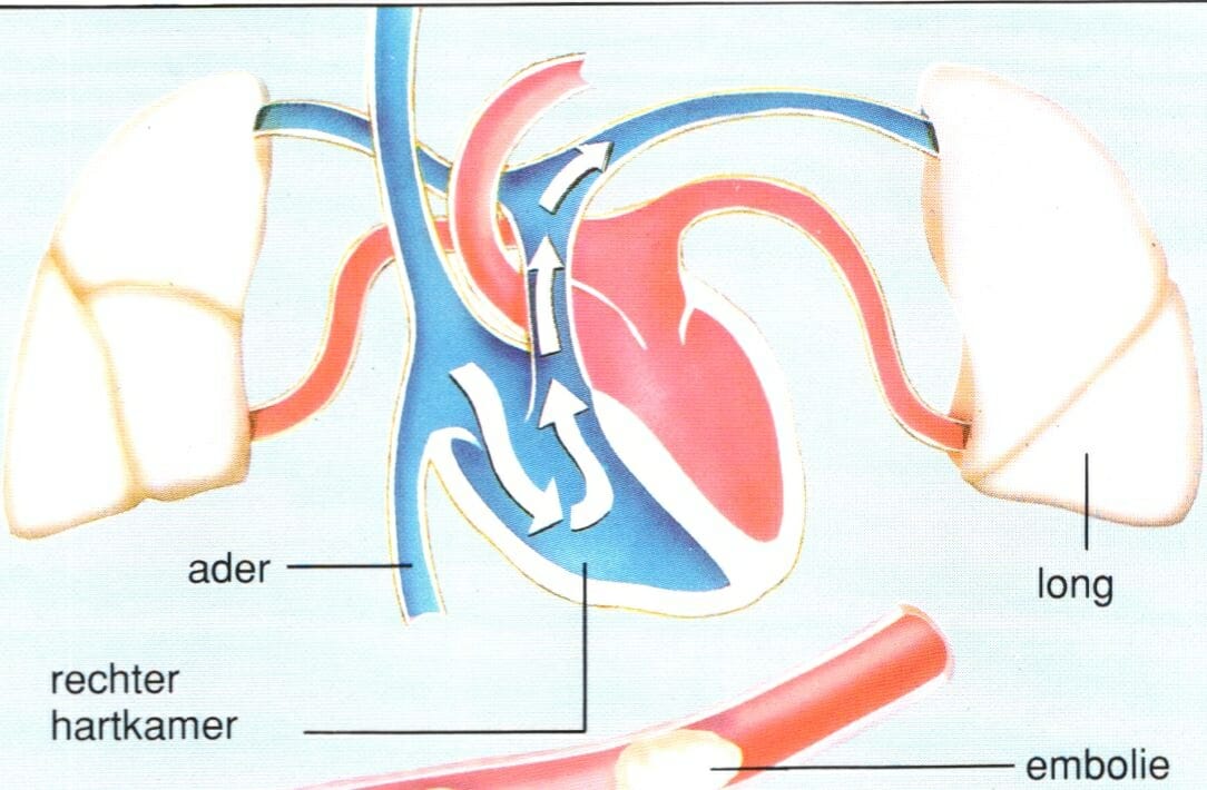 Longembolie | Ademhaling | Menselijk Lichaam - Menselijk Lichaam