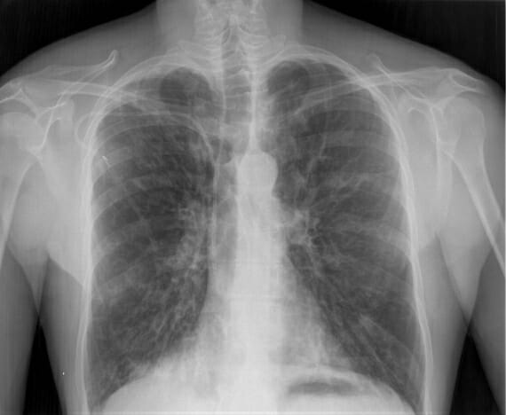 Longoedeem | Ademhaling | Menselijk Lichaam - Menselijk Lichaam