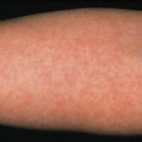 Rodehond: oorzaken, symptomen, behandeling en vaccinatie - Menselijk ...