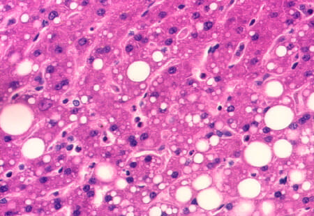 Steatose | Algemeen | Menselijk Lichaam - Menselijk Lichaam