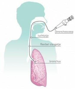 Bronchoscopie | Longen | Menselijk Lichaam - Menselijk Lichaam