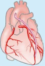 Bypass operatie | Algemeen | Menselijk Lichaam - Menselijk Lichaam