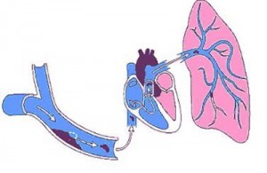 Embolie | Algemeen | Menselijk Lichaam - Menselijk Lichaam