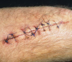 Soorten hechtingen | Eerste hulp - EHBO | Menselijk Lichaam - Menselijk ...