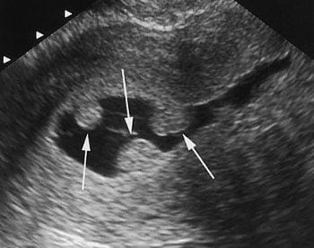 Poliep in baarmoeder | Algemeen | Menselijk Lichaam - Menselijk Lichaam