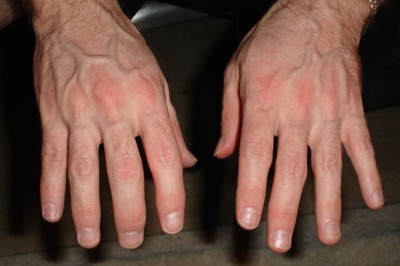 Reumatoïde artritis | Algemeen | Menselijk Lichaam - Menselijk Lichaam