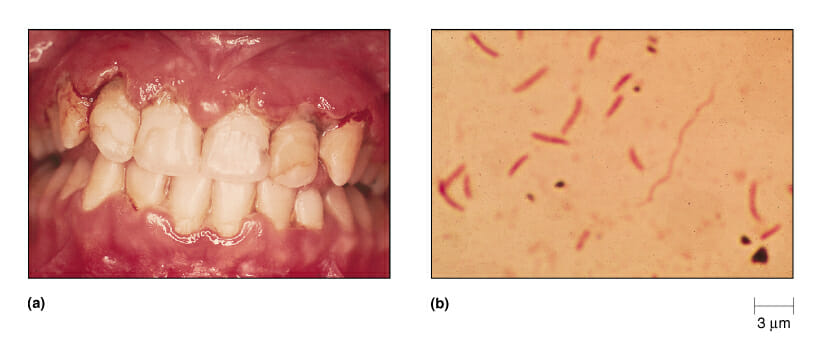 Stomatitis van plaut-vincent | Tanden | Menselijk Lichaam - Menselijk ...
